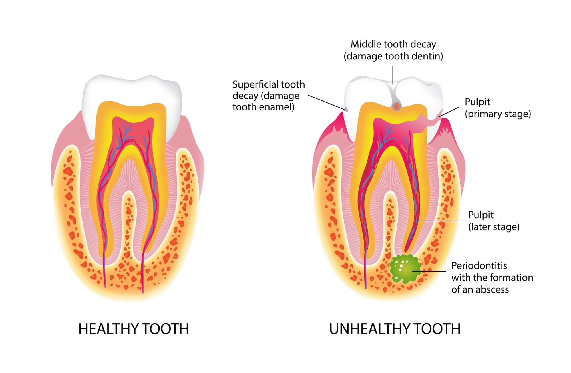 Abscessed Tooth Dangers: Ways Prevent A Dental Abscess From Happening ...